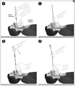 Bougie-Assisted Tactile Blind Digital Intubation – airwayNautics