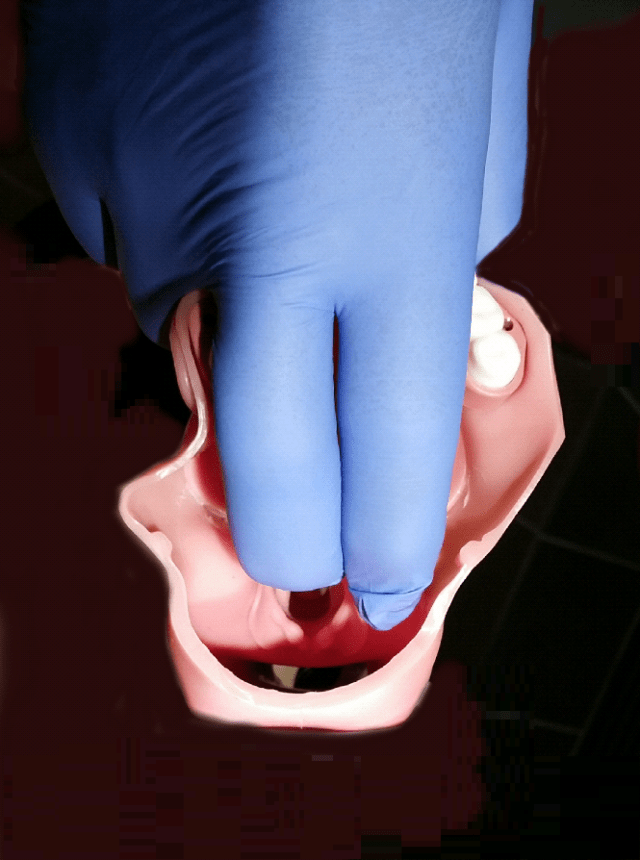 Bougie-Assisted Tactile Blind Digital Intubation – airwayNautics