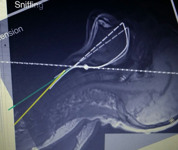 Elevate the Head/Put the Head Forward: Twitter passions on head, neck ...